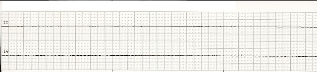 Pediatric Advance Life Support: Aystole Part 2