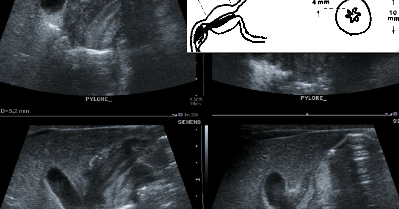 Ma bibliothèque en Imagerie Médicale: STENOSE HYPERTROPHIQUE DU PYLORE