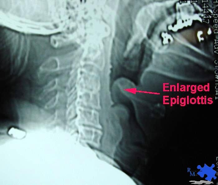 MEDICINA: EPIGLOTITIS o SUPRAGLOTITIS