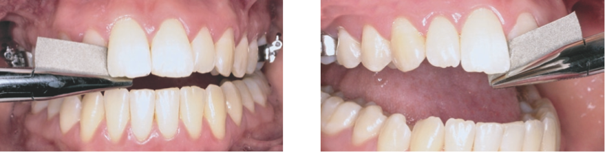 ORTODONTIA CONTEMPORÂNEA: Desgaste interproximal e suas implicações ...