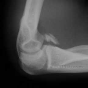 Fratura da Coronoide no Cotovelo