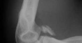 Fratura da Coronoide no Cotovelo