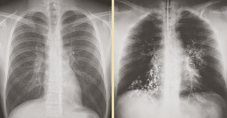 PATOLOGÍA HUMANA: agosto 2014