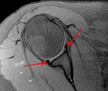 MRI Musculo-Skeletal Section: Labrum