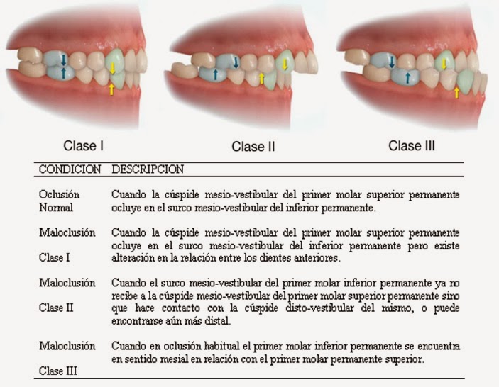 Estudiantes de Odontología: Clasificación MOLAR DE ANGLE