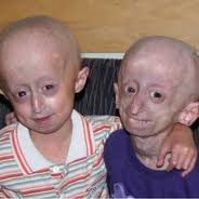 Datos curiosos de la medicina: PROGERIA