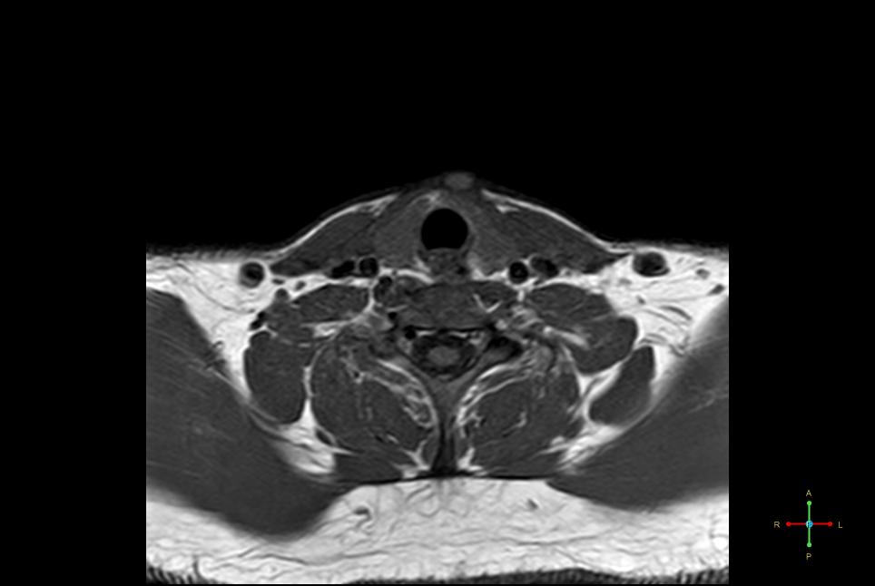 Thyroglossal cyst-CT - Sumer's Radiology Blog