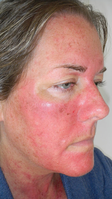 Efudex and Me 2013: Efudex Day Sixteen