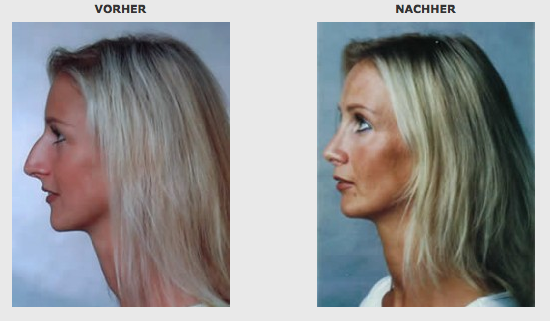 Rhinoplasty Journey: Prof. Dr. Werner Mang, Germany
