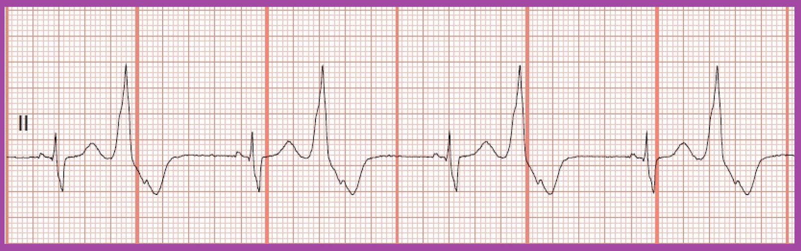Practice Rhythm Strips 280