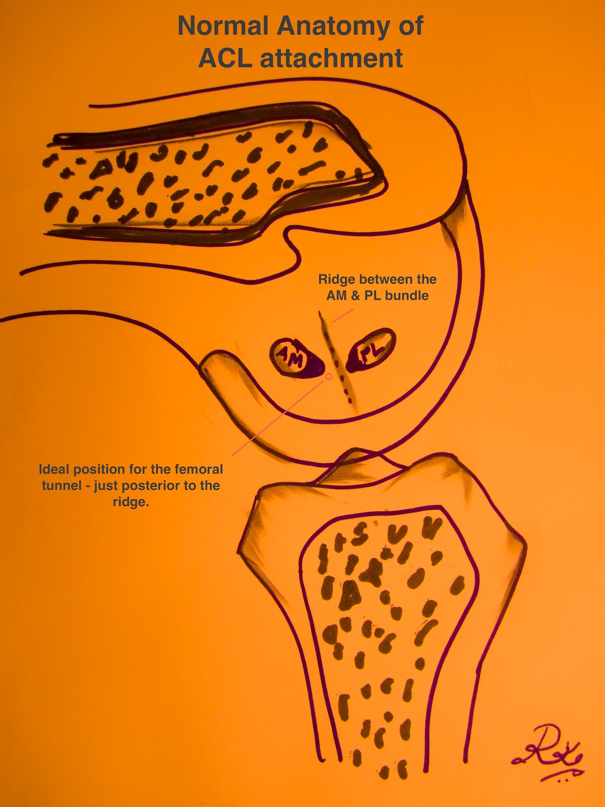 Indiaorthosurgeon: Tunnel placement in Anatomical ACL reconstruction