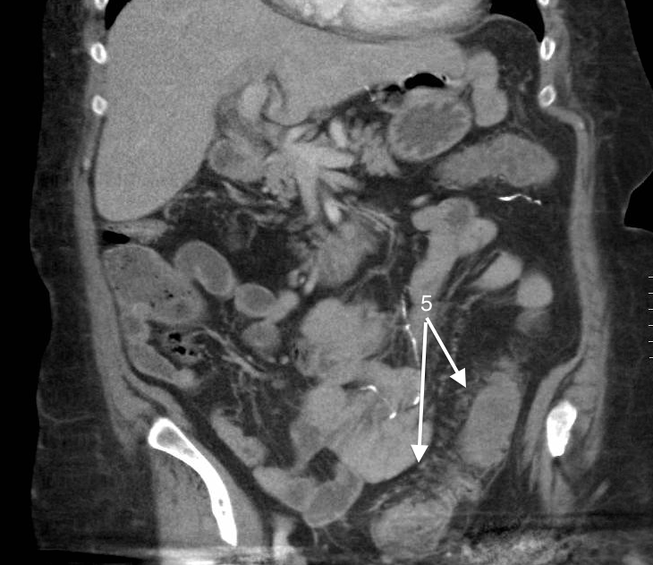 Cases and Images in Infectious Disease: Acute Colitis due to ...