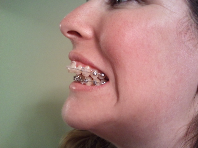 Jenn's Jaw Surgery: Before pics