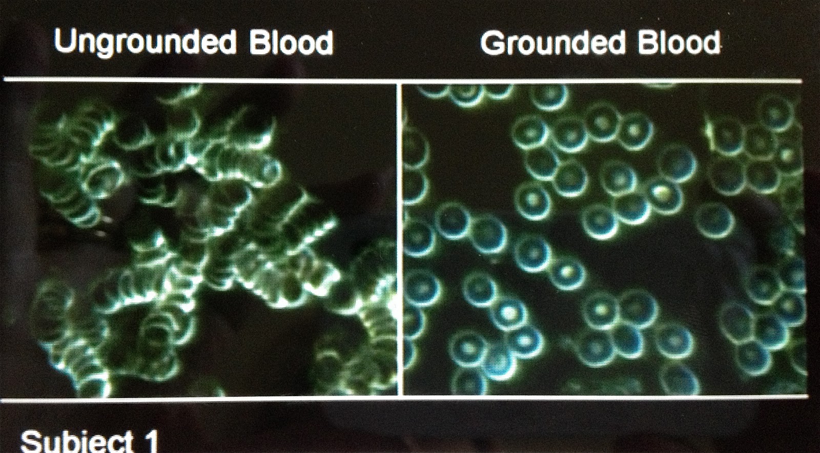 Earthing the Earthling: Blood Thinning with Earthing