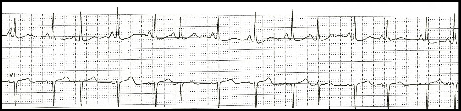 EKG Rhythm Strip Quiz 119