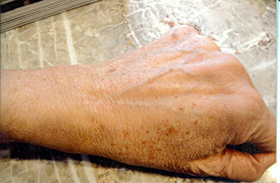 How to hide or remove spots and freckles on hands