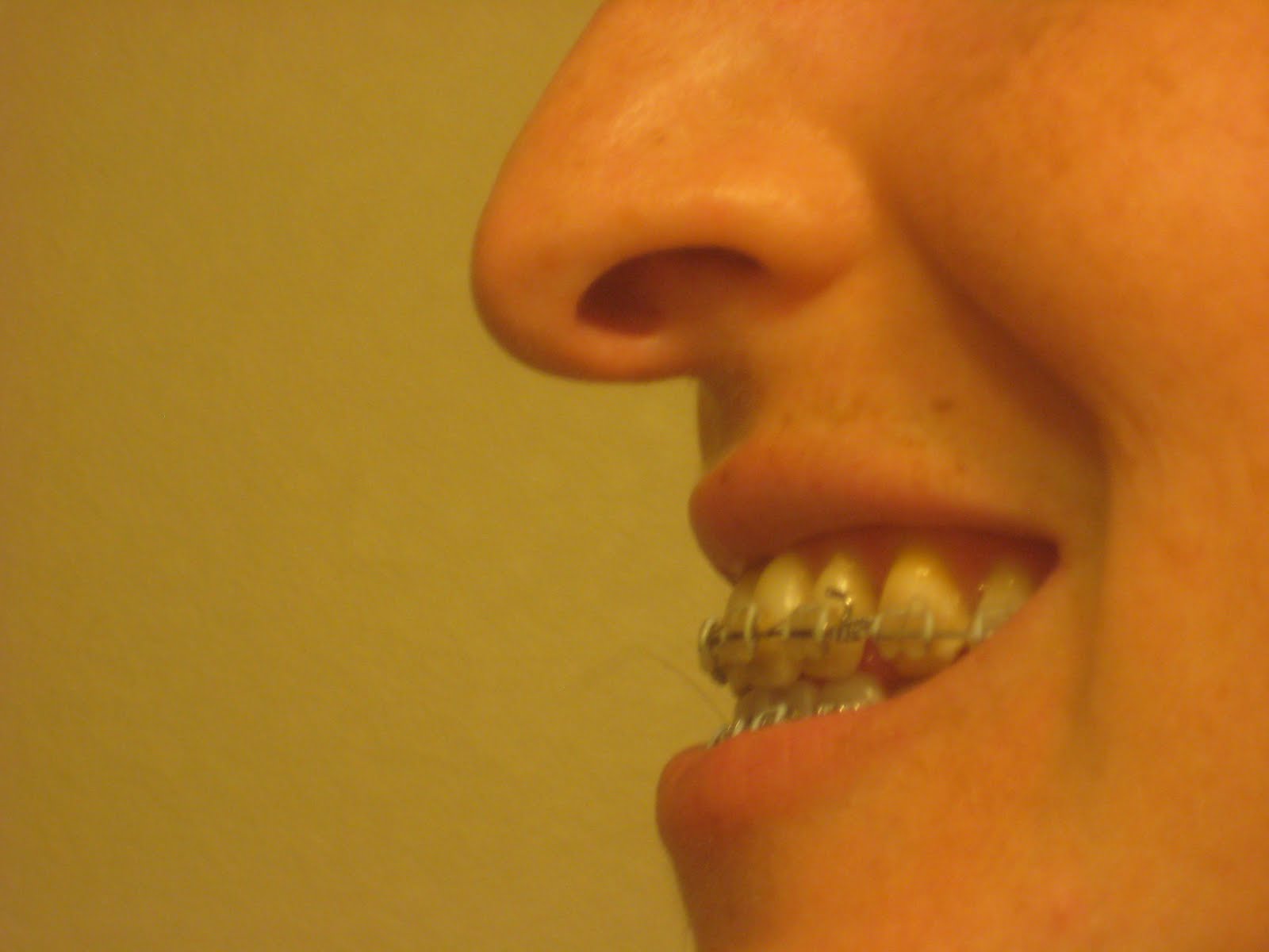 SARPE, Jaw Surgery and Adult Braces, Oh My!: Lower surgery date ...