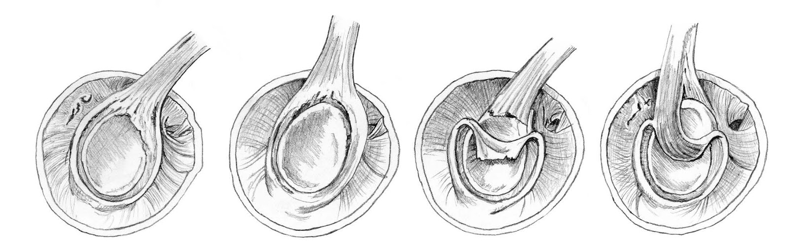 The Different Types of SLAP Lesions and their Treatment