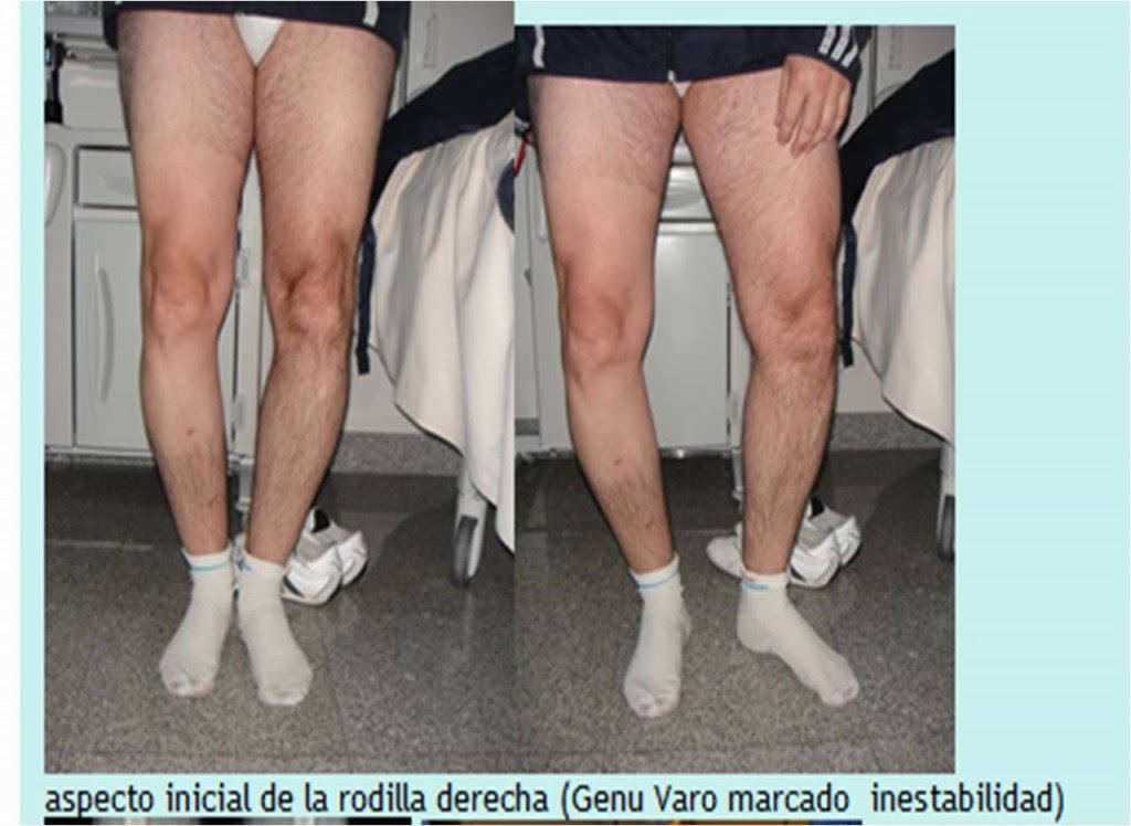 Patologías en rodilla: Genu Varo
