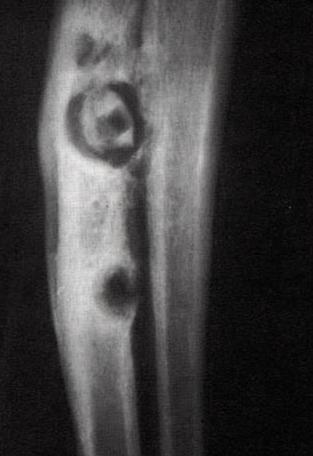 Ring Sequestrum- Plain Film - Sumer's Radiology Blog