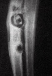 Ring Sequestrum- Plain Film - Sumer's Radiology Blog
