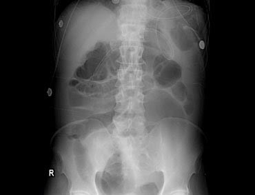 My Radiology World: Volvulus