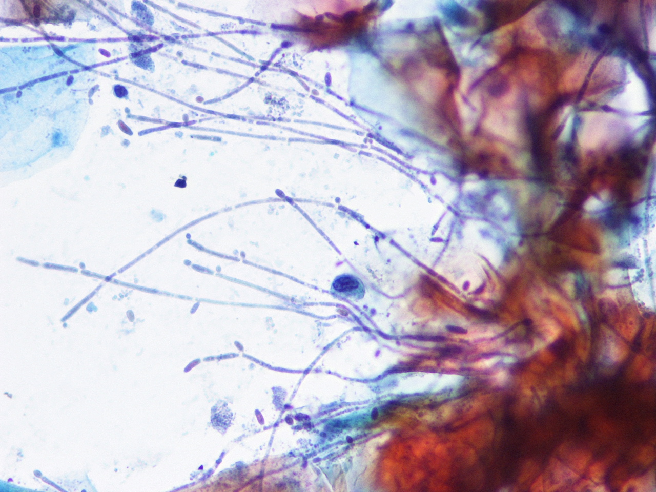 Citomed Citologia: ESFREGAÇOS INFECCIOSOS - CANDIDA