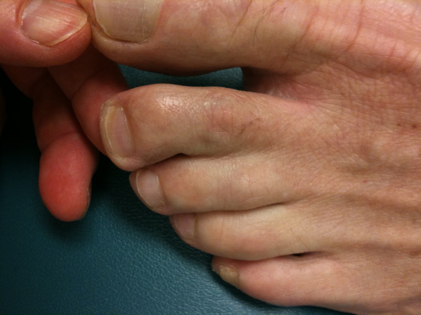 ORTHOPODY: Congenital foot deformities