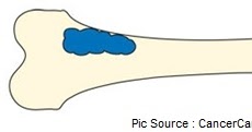 Stages of Bone Cancer