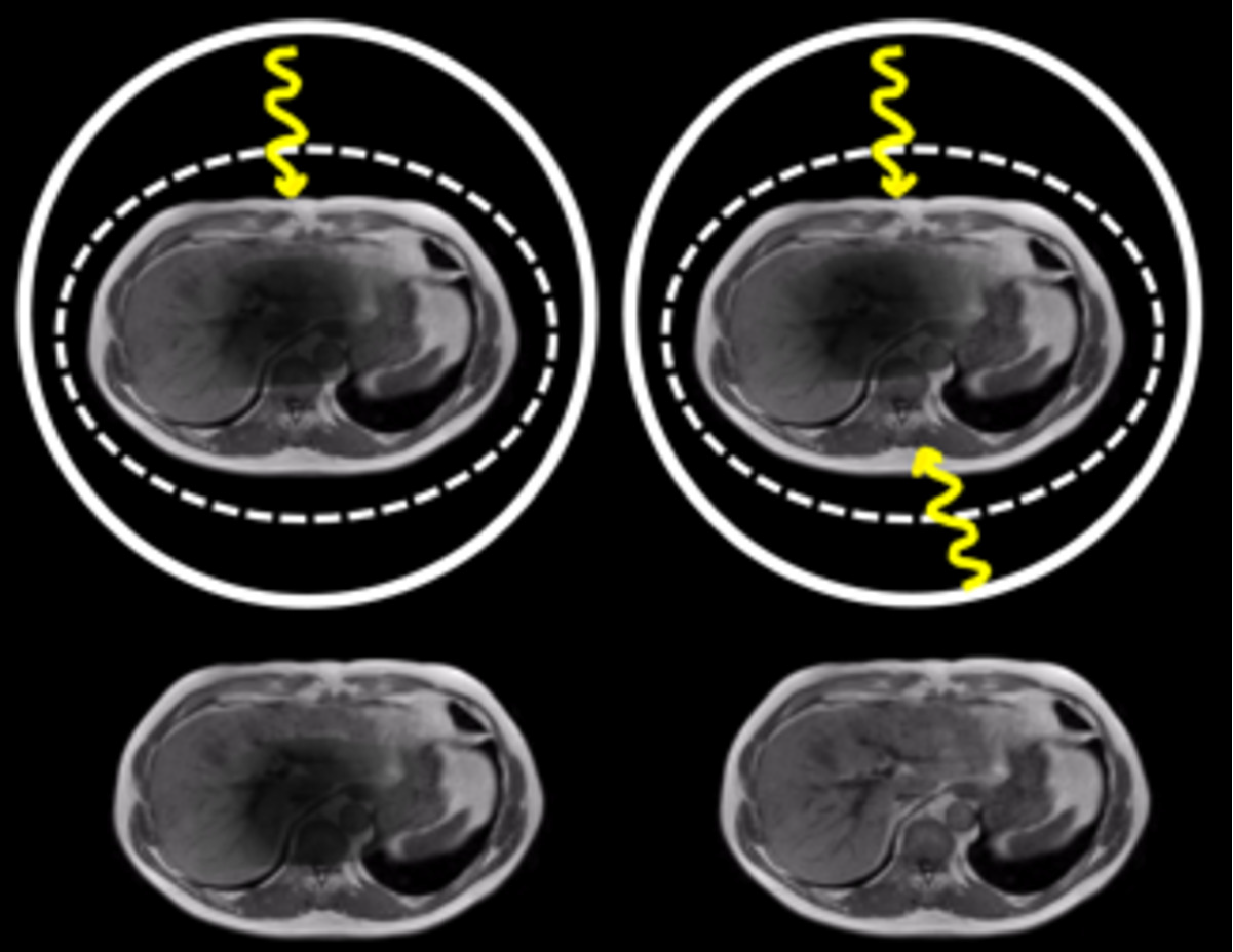 Radiology Community: Dielectric shading artifacts in high field ...