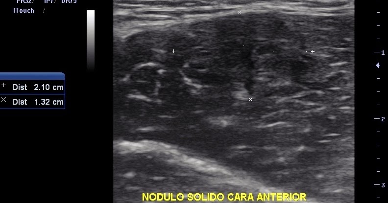 Nodulo solido muslo