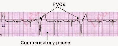 Premature Ventricular Contraction / Ventrikular Ekstrasistol | INA - ECG
