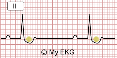 Bloc d´un Metge de Família: Digoxina en l'Electrocardiograma