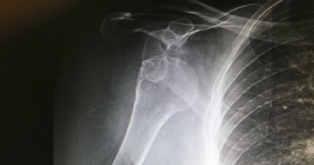 Joint Preservation and Replacement : painful dislocated rt shoulder in ...