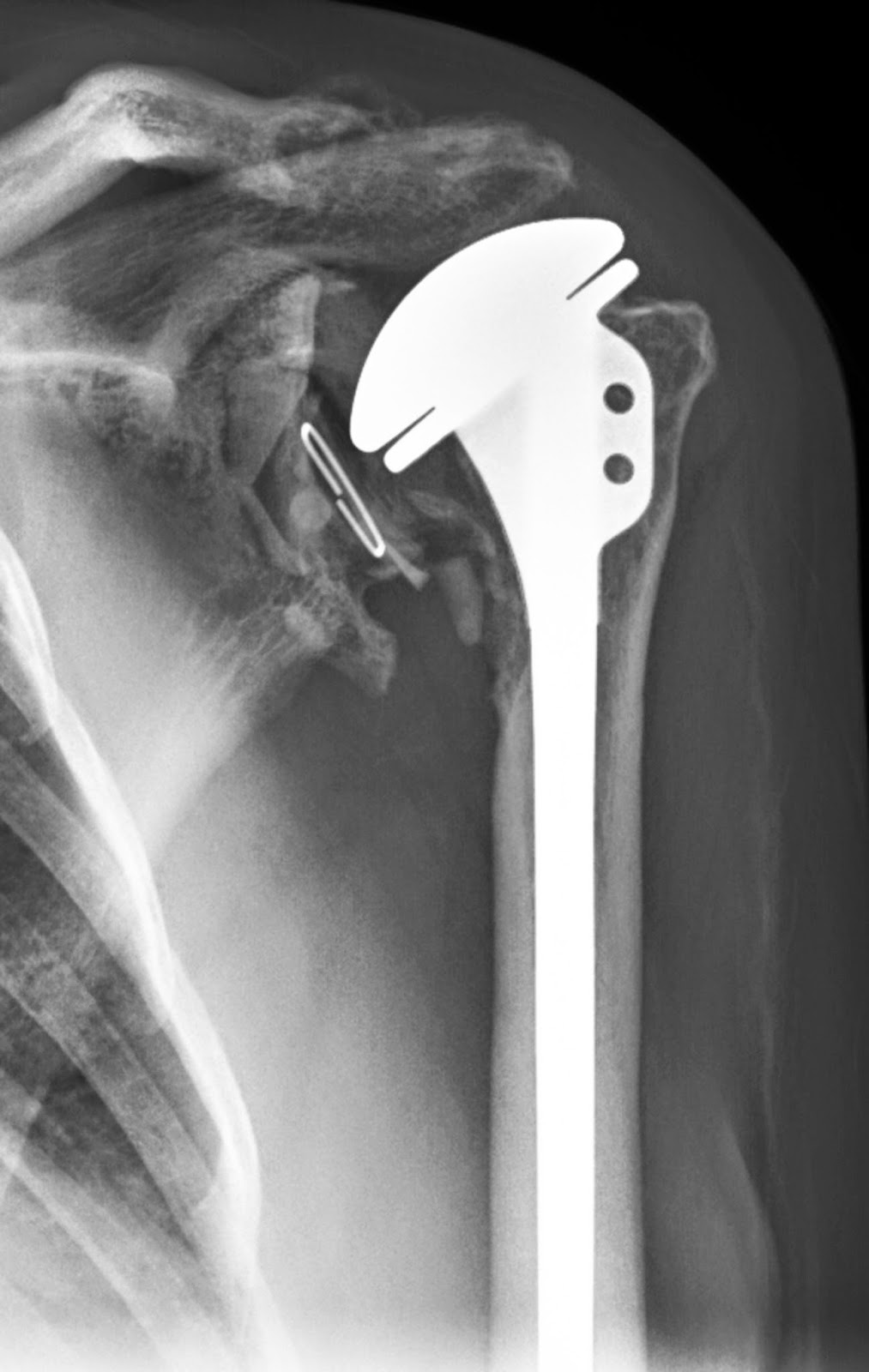 UW Shoulder and Elbow Academy: Failure of anatomic total shoulder joint ...