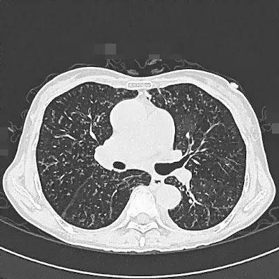 CXR 胸部x光判讀 Diffuse panbronchiolitis
