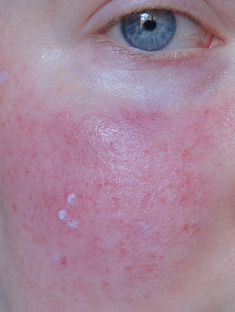 Scarlet Letters, dealing with vascular rosacea, face flushing, burning ...