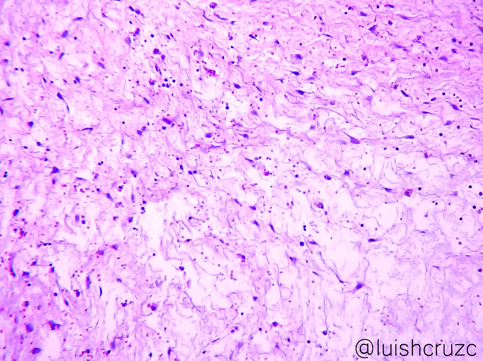 Patología CC: Angiomixoma profundo (agresivo)