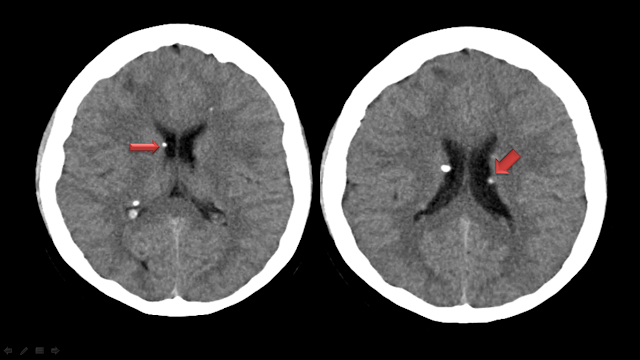 Ultimate Radiology : Plain CT Brain findings in an adolescent patient ...