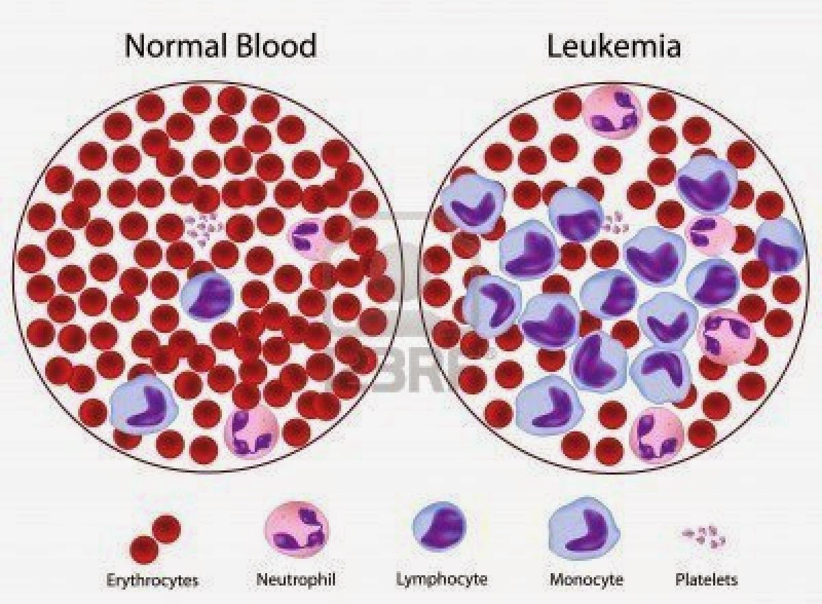 Acute Lymphoblastic Leukemia (ALL): Pathophysiology
