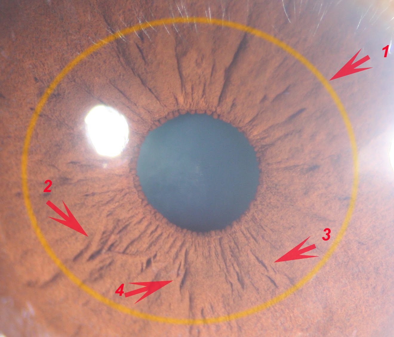 Modern & Multidimensional Iridology: Physical Collarette Analysis -3h