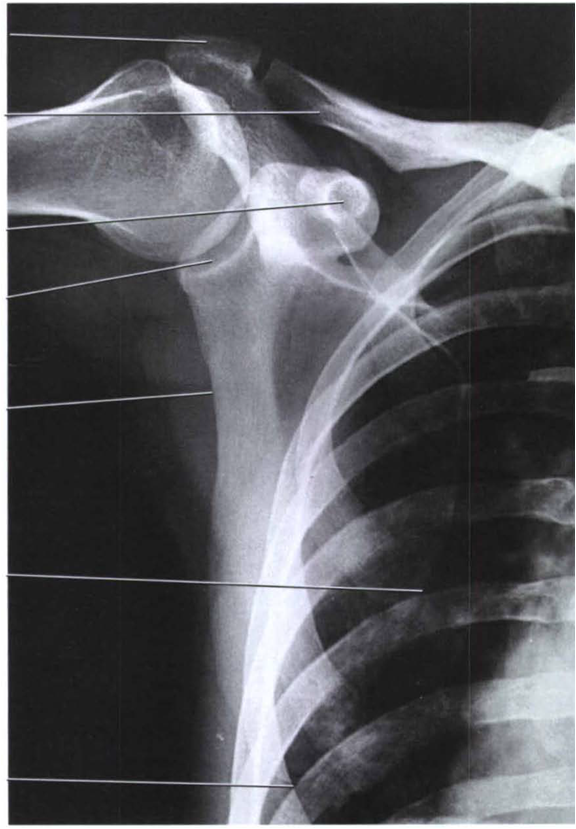 TEKNIK RADIOGRAFI SCAPULA - Radiografer