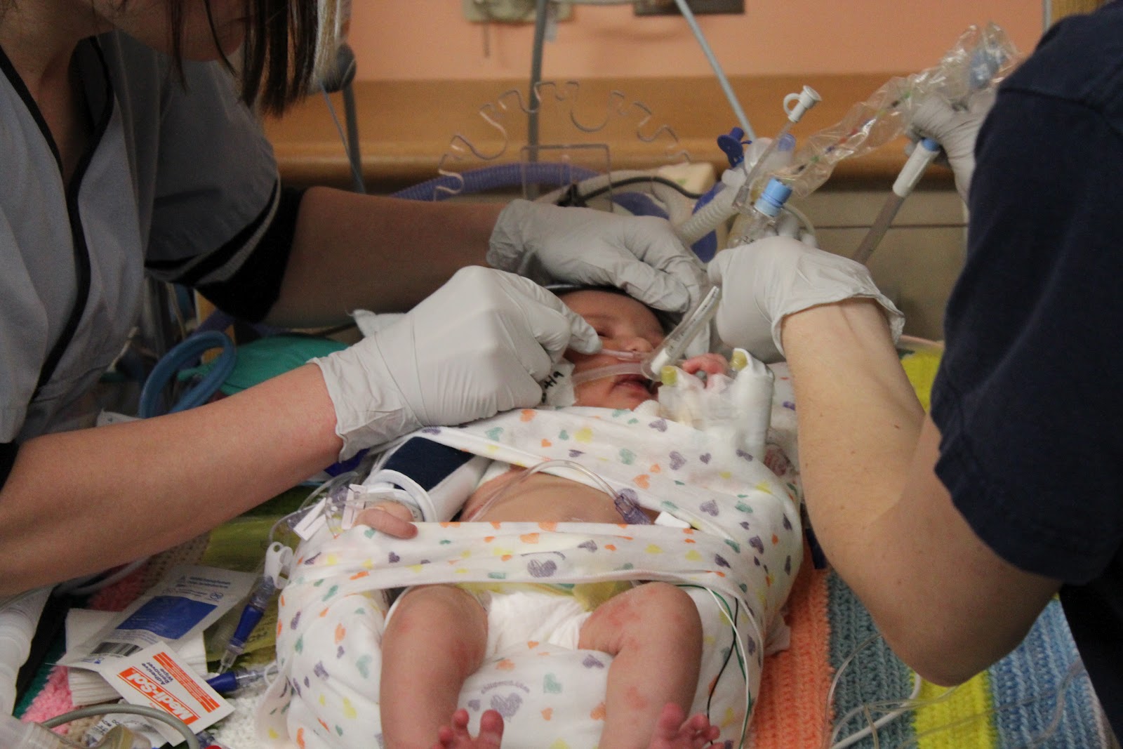 Baby Luna's CDH Story: Extubated!!!