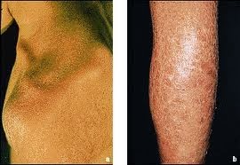 Medical Treatment Pictures-for Better Understanding: Conradi-Hunermann ...