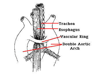 MEDICAL FACTS AND MCQ'S: Vascular ring and Double aortic arch