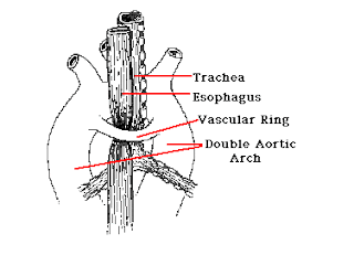 MEDICAL FACTS AND MCQ'S: Vascular ring and Double aortic arch