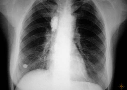 Alternative Health News: How To Deal With Children’s Primary Complex