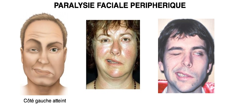 Récap' IDE: La paralysie faciale périphérique