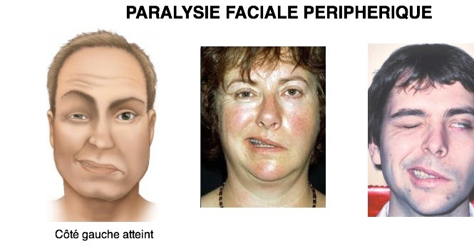 Récap' IDE: La paralysie faciale périphérique