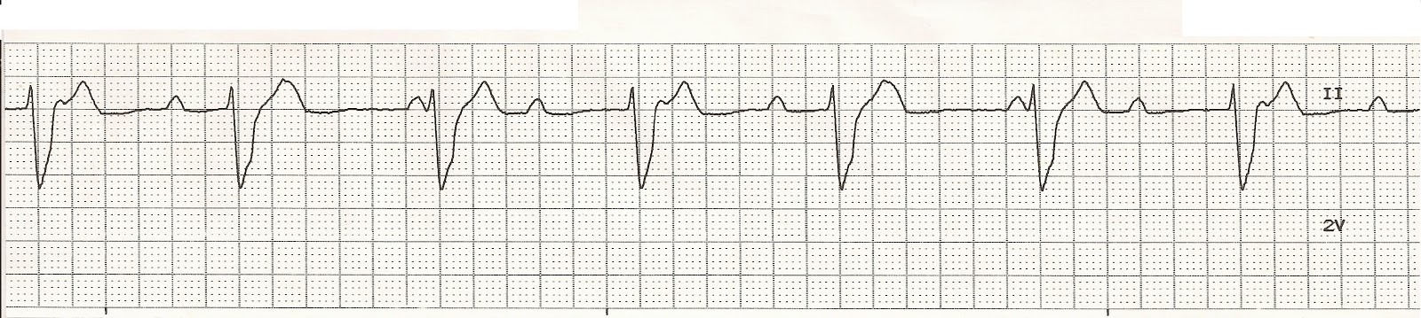 ACLS Rhythms: Heart blocks